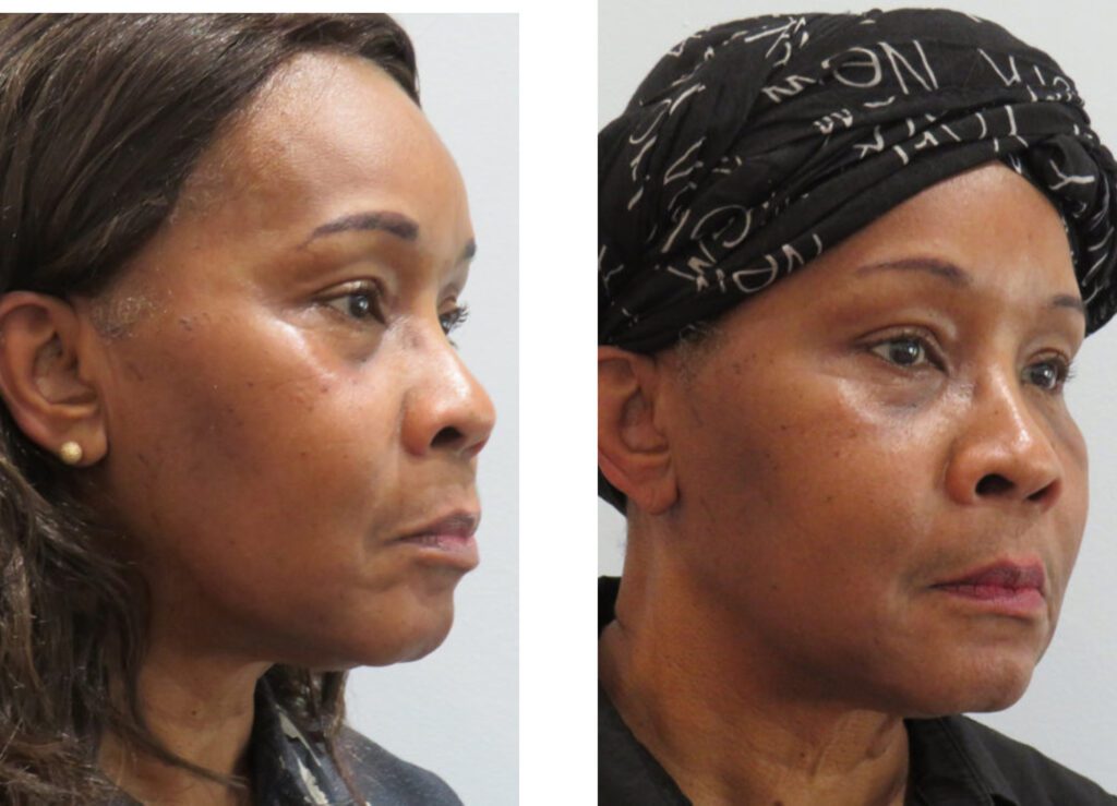 Vampire-Facelift | About Face